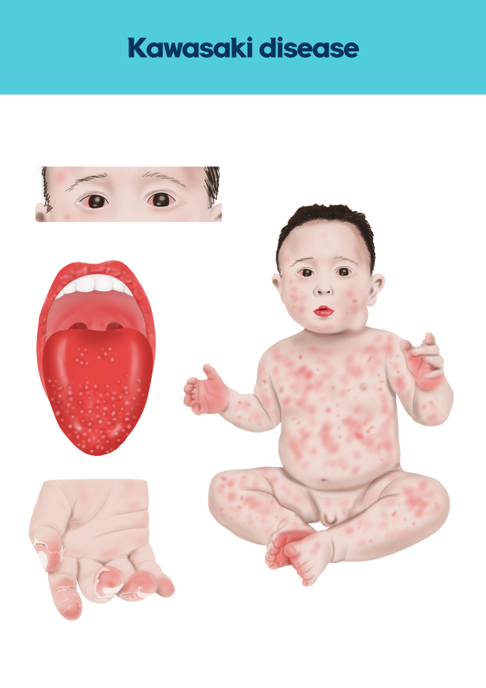 Kawasaki Disease