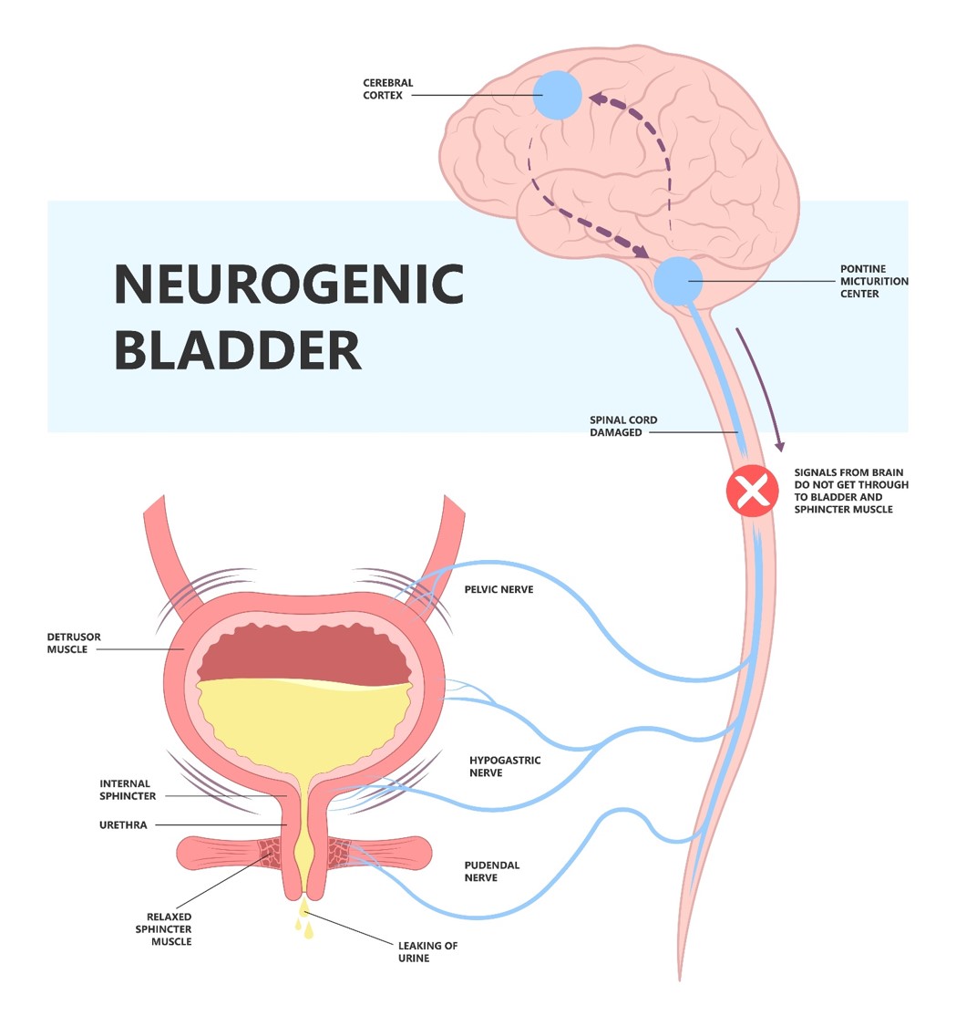 Neurogenic Bladder Over Tiem Online | emergencydentistry.com