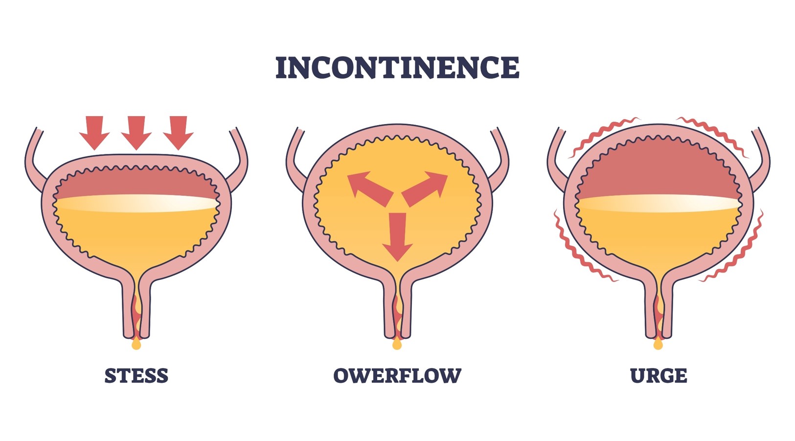 Urinary Incontinence - Pedigogy