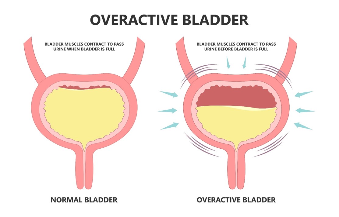 Overactive Bladder 膀胱過動症 | 衛教單張 - 中國醫藥大學附設醫院