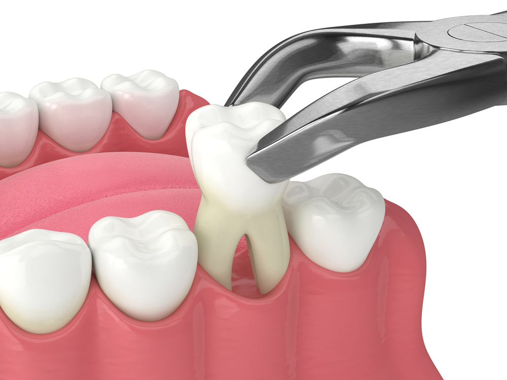 Wisdom Teeth In Chinese