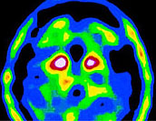 多巴胺轉運體掃描 (99mTc-TRODAT-1 SPECT) | 最新消息 - 中國醫藥大學附設醫院