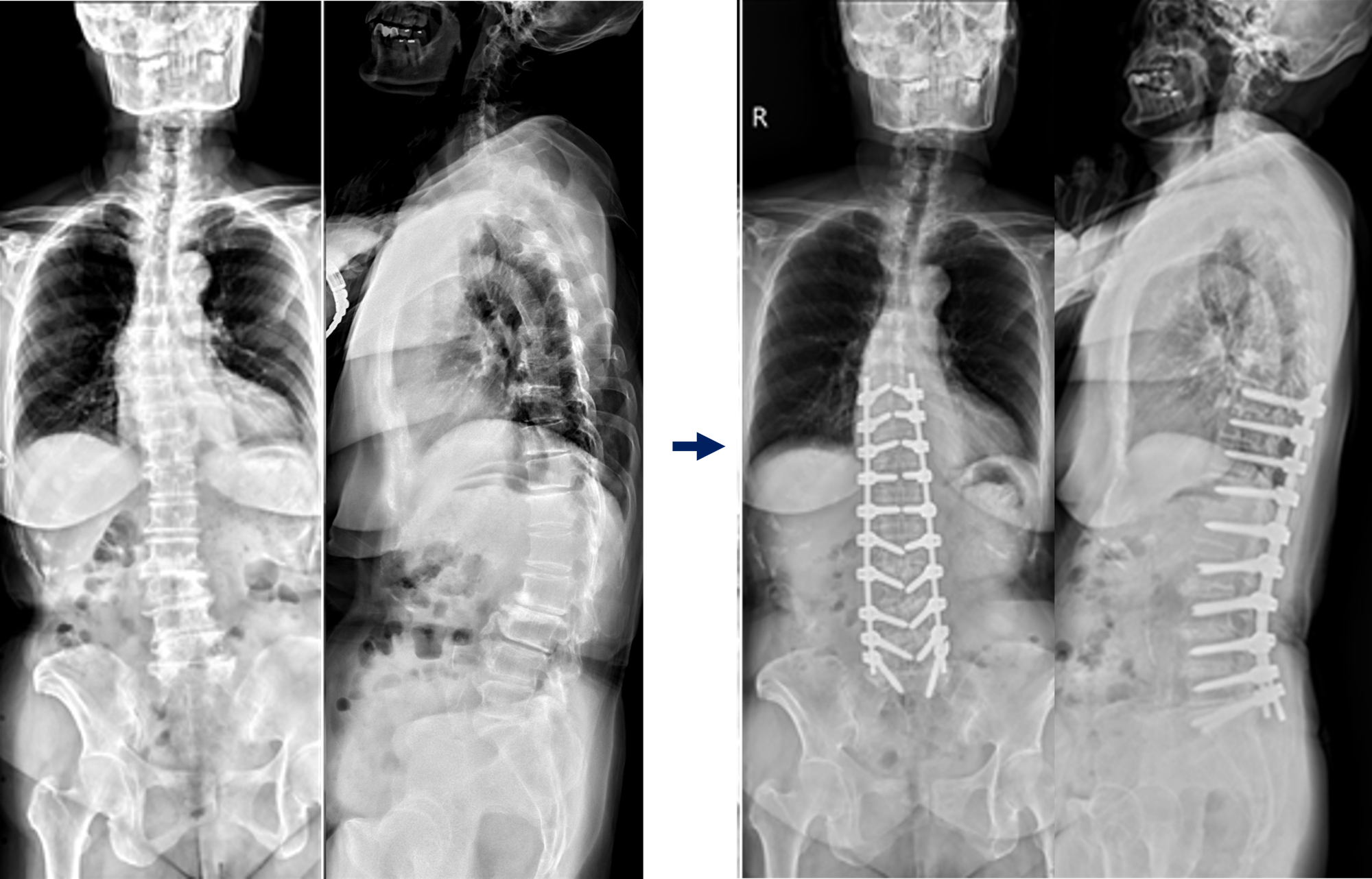 O-arm Navigation - Assisted Minimally Invasive Spine Surgery - China ...