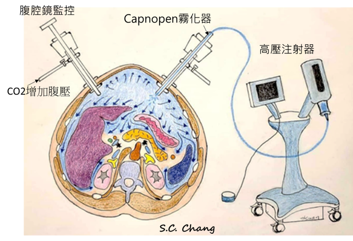 腹膜腫瘤治療新利器！腹腔高壓氣霧化學療法（PIPAC- Pressurized IntraPeritoneal Aerosol ...