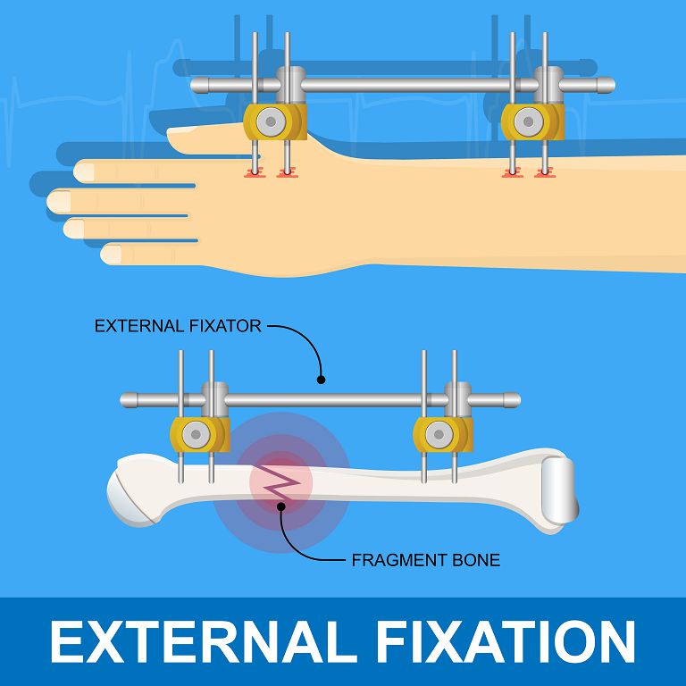 Nursing Care of External Fixation Devices 裝置骨外固定器照護 | 衛教單張 - China ...