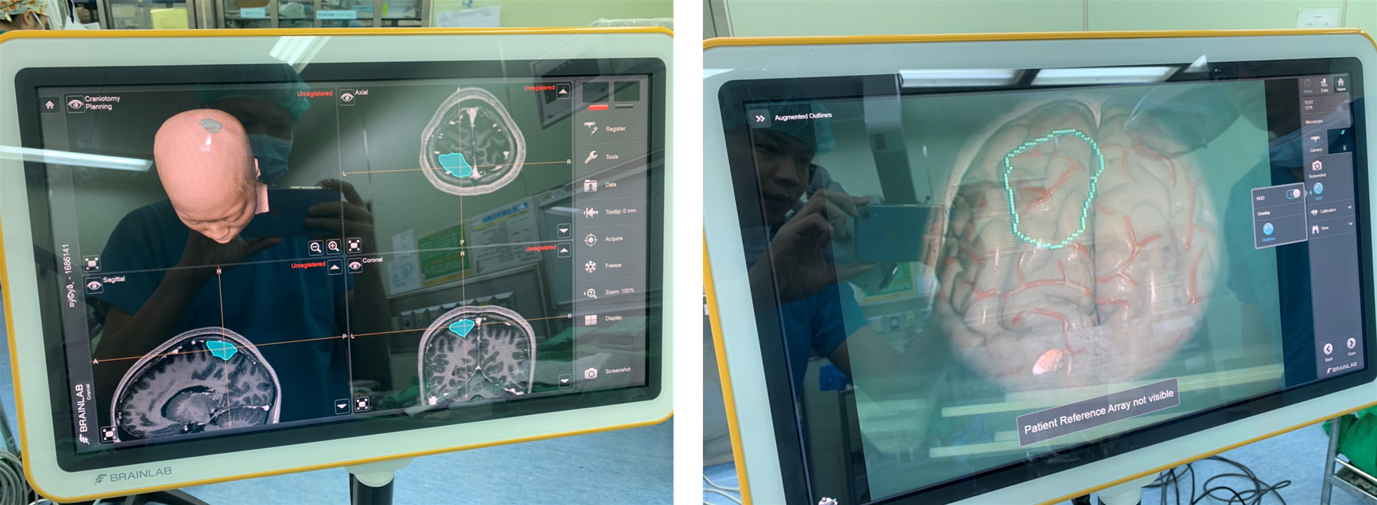 Virtual Reality-assisted Neurosurgery - China Medical University Hospital