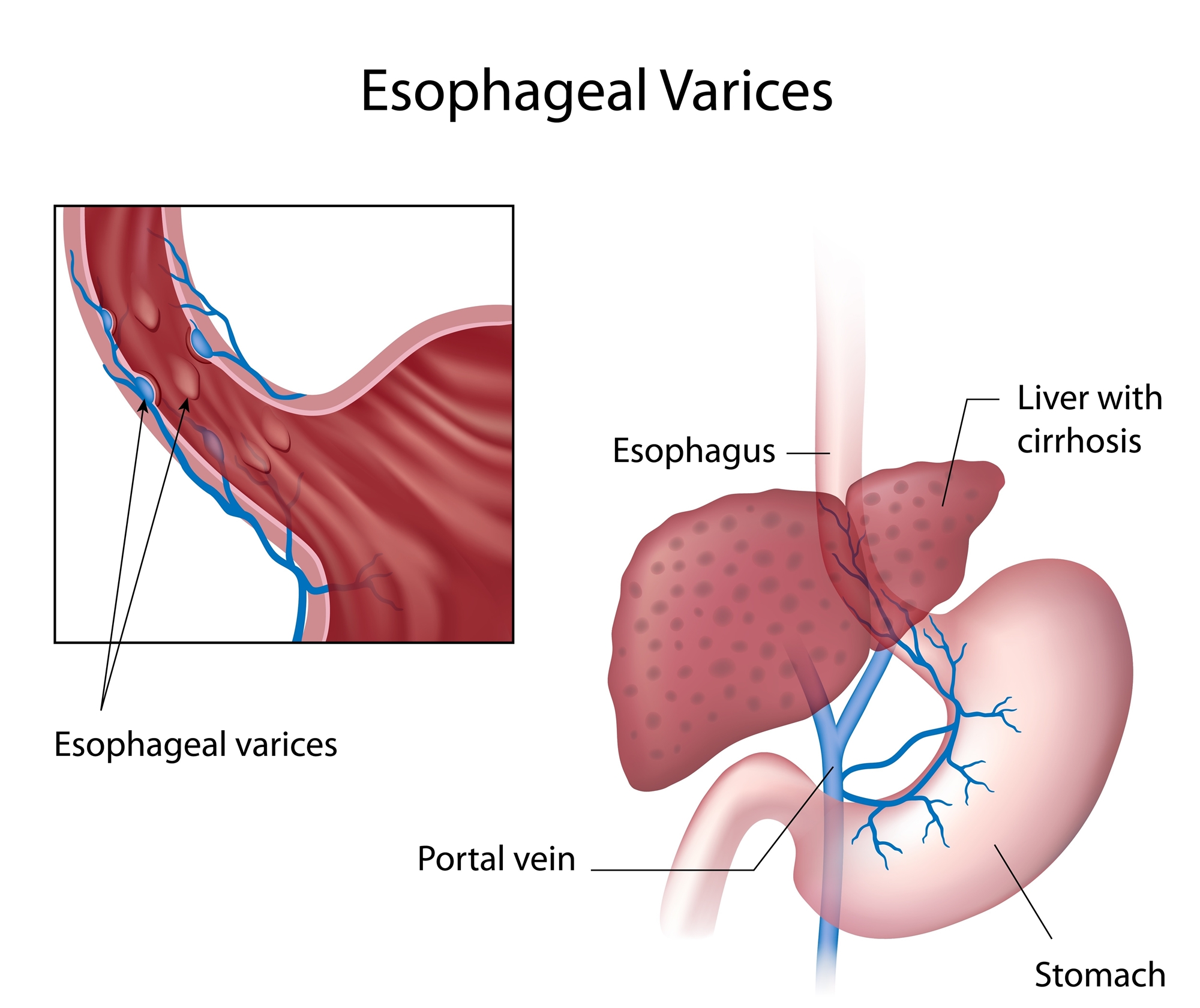 Esophageal Varices And Bleeding 食道靜脈曲張及出血 衛教單張 中國醫藥大學附設醫院