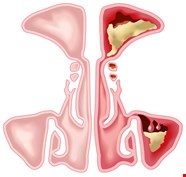 Sinus Drainage Color Meaning In Chinese Age Infoupdate